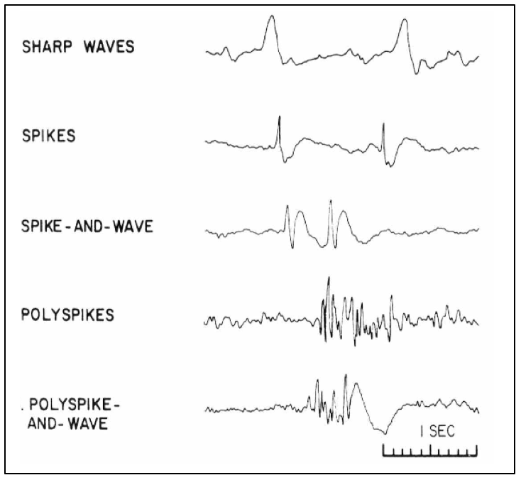 Examples of Interictal Epileptiform abnormalities are: